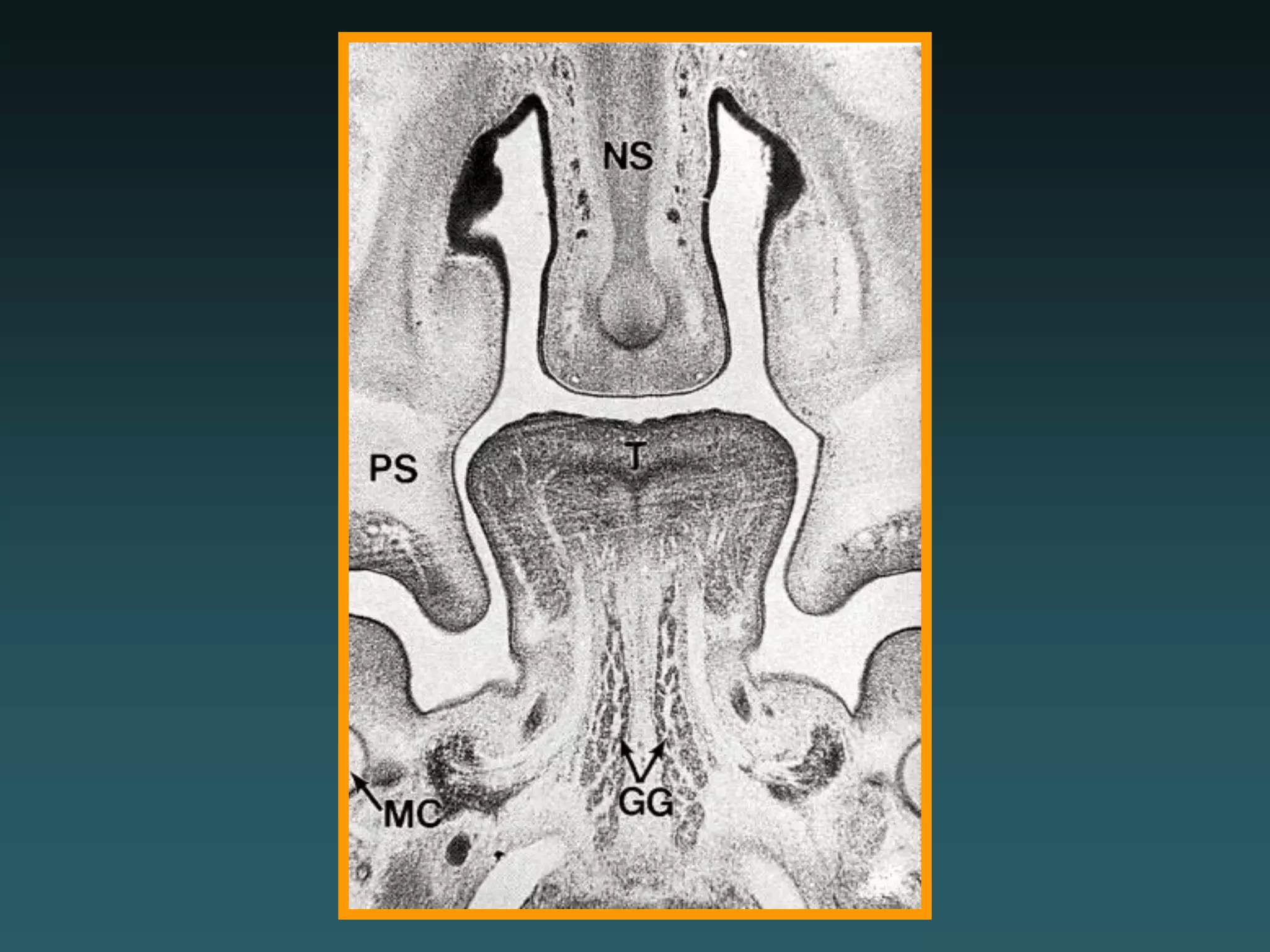 Craniofacial embryology Implications for craniofacial syndromes - July ...