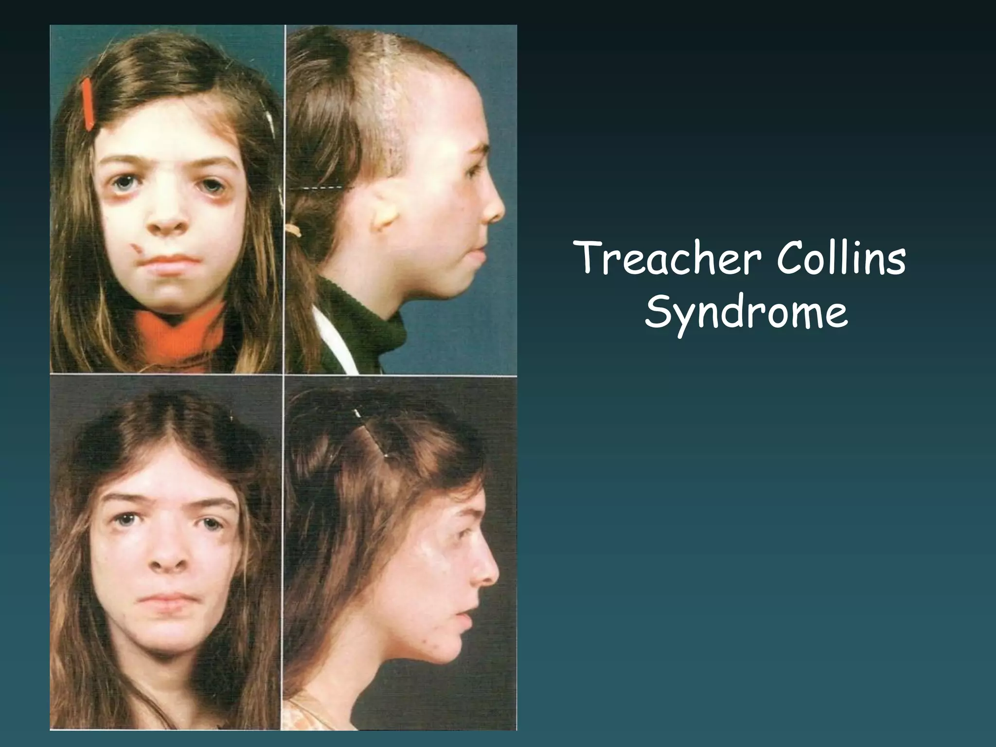 Craniofacial embryology Implications for craniofacial syndromes - July ...