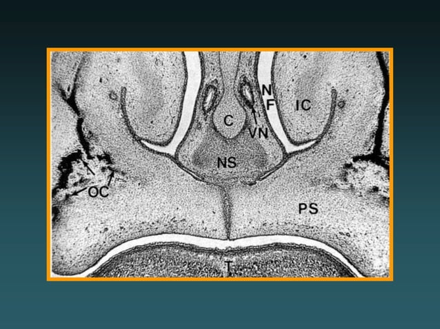 Craniofacial embryology Implications for craniofacial syndromes - July ...