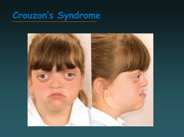 Craniofacial embryology Implications for craniofacial syndromes - July ...
