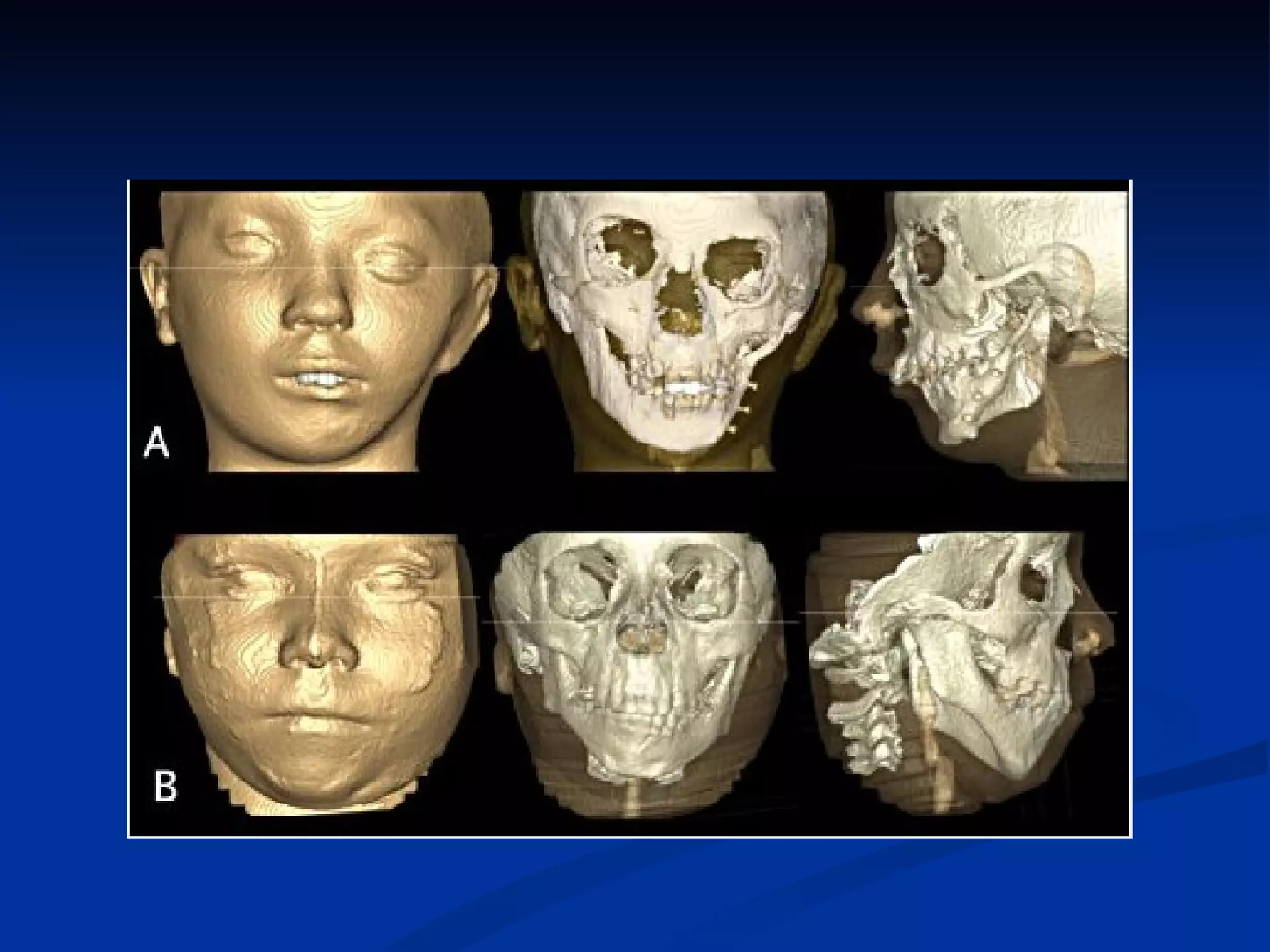 Craniofacial microsomia | PPT
