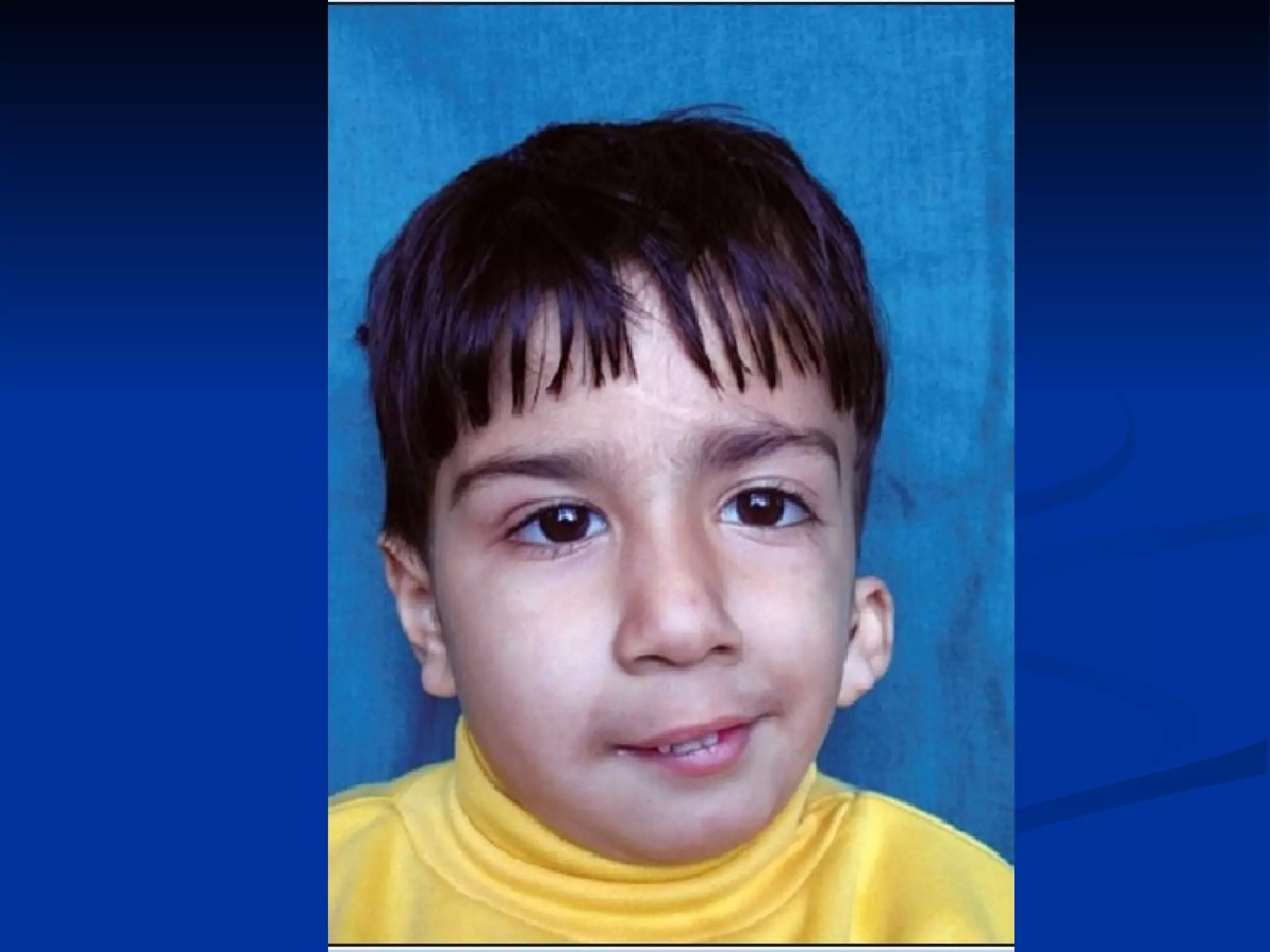 Craniofacial microsomia | PPT