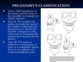 Craniofacial microsomia | PPT