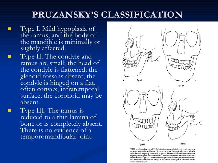 Craniofacial microsomia