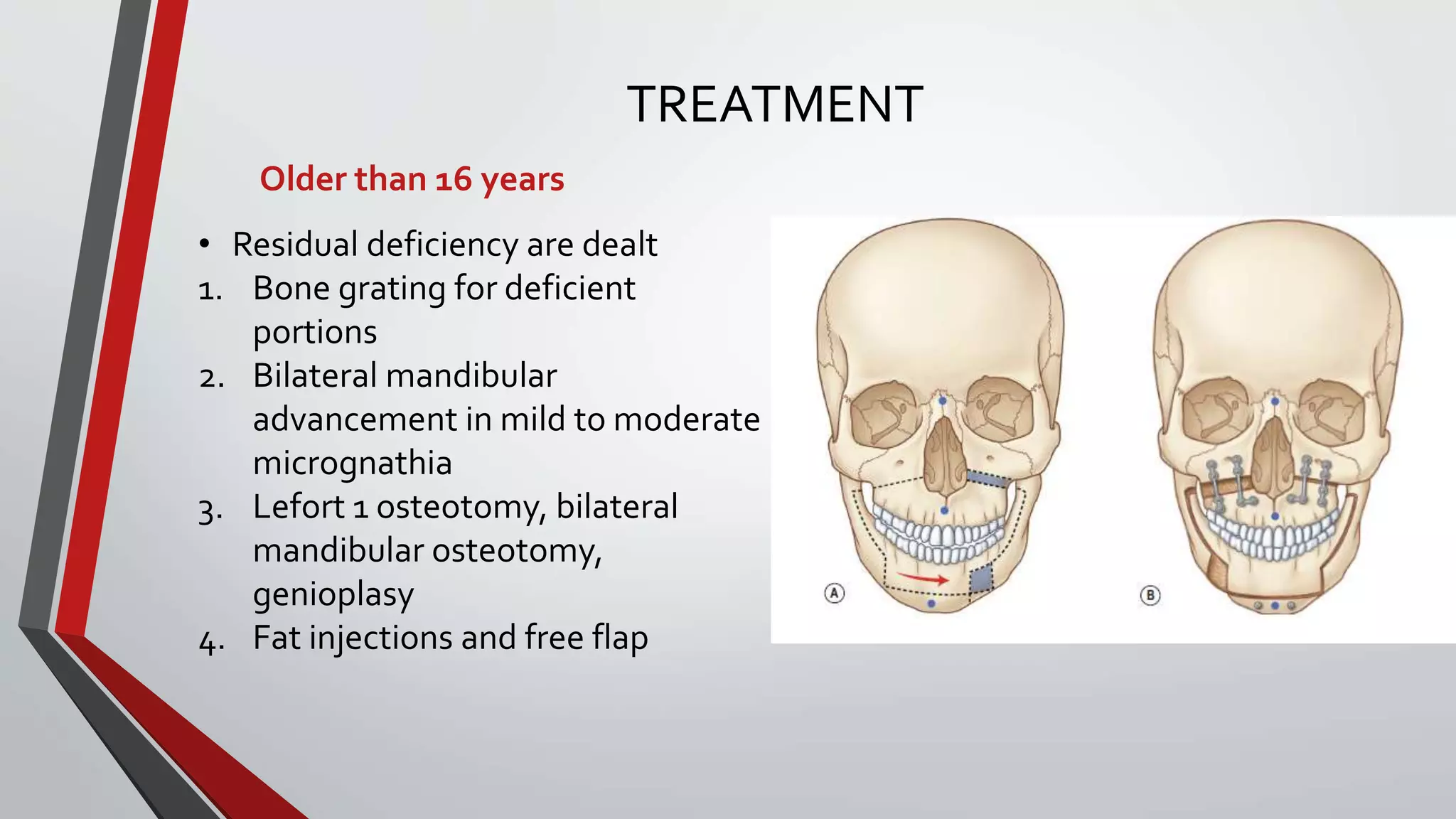 Craniofacial Microsomia | PPTX