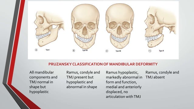 Craniofacial Microsomia | PPTX | Ear, Nose and Throat Conditions ...