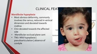 Craniofacial Microsomia | PPTX