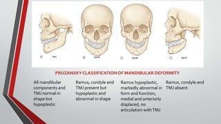 Craniofacial Microsomia | PPT