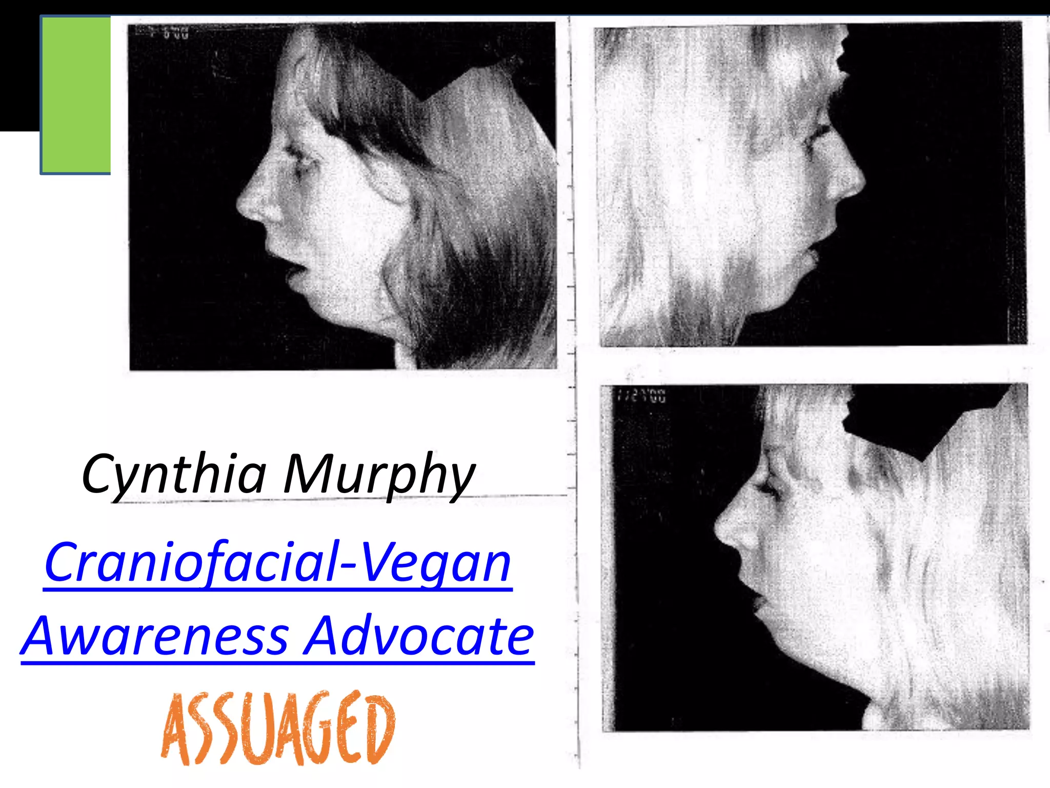 The Psychological Impact of Children born with Craniofacial ...