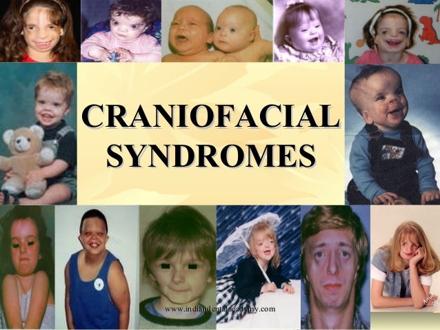 Craniofacial syndromes