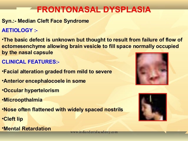 Craniofacial syndromes