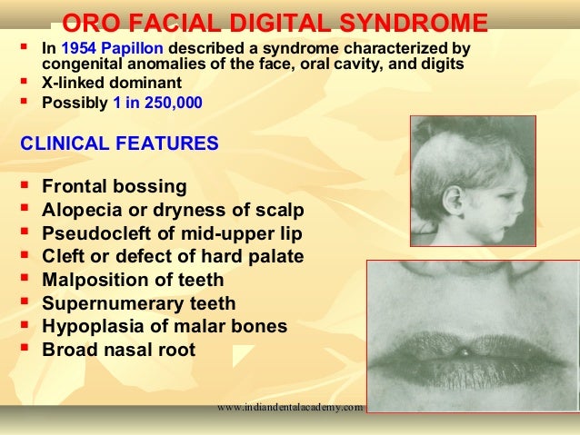 Craniofacial syndromes