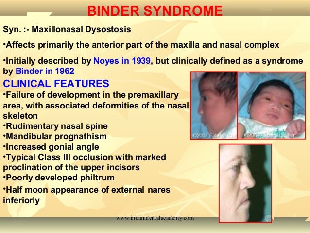 Craniofacial syndromes