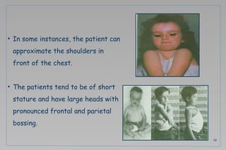 Craniofacial syndromes in orthodontics and the affect in the ortho ...