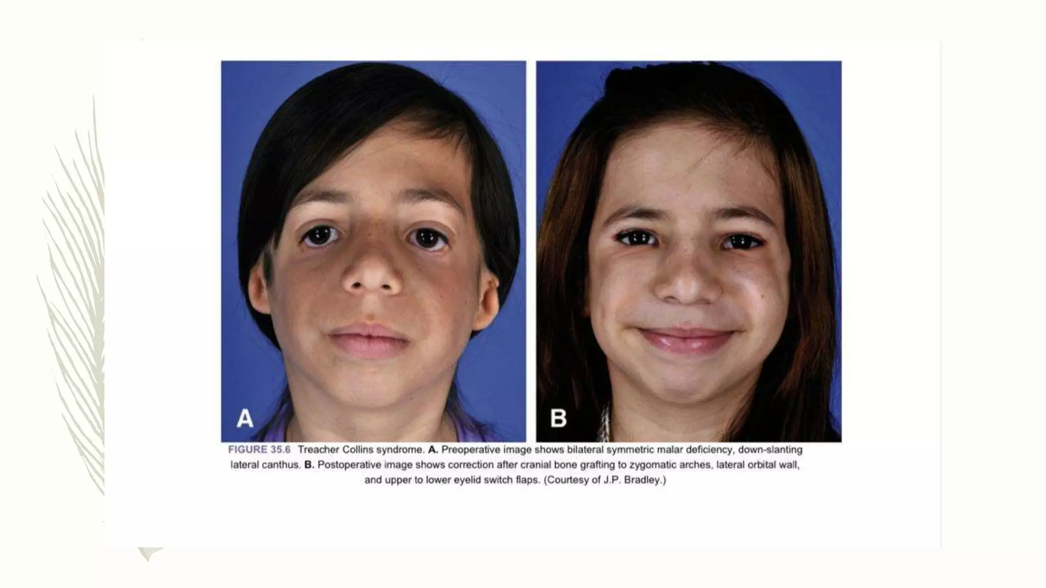 Craniofacial Tumors and Condition | PPTX