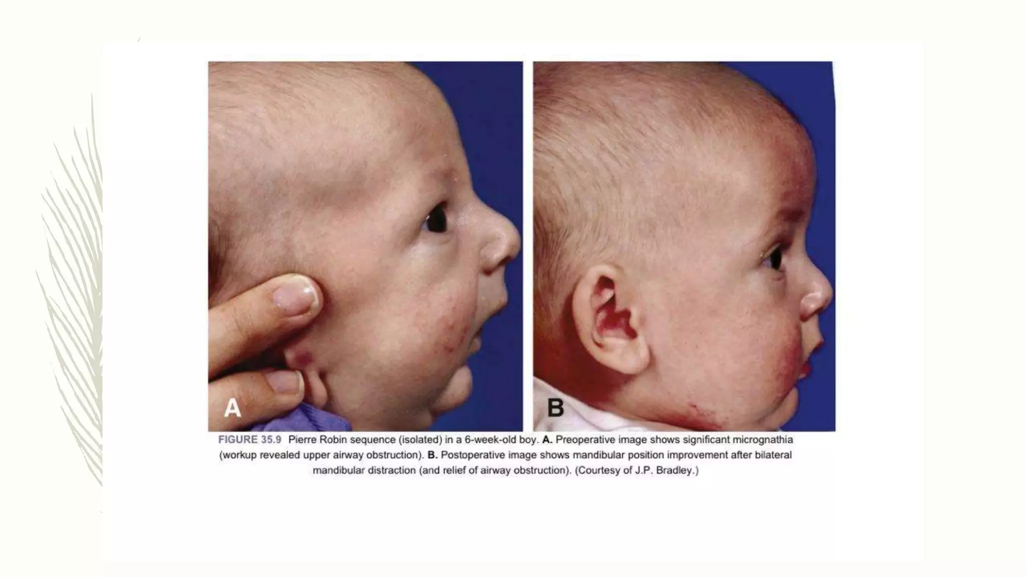 Craniofacial Tumors and Condition | PPTX