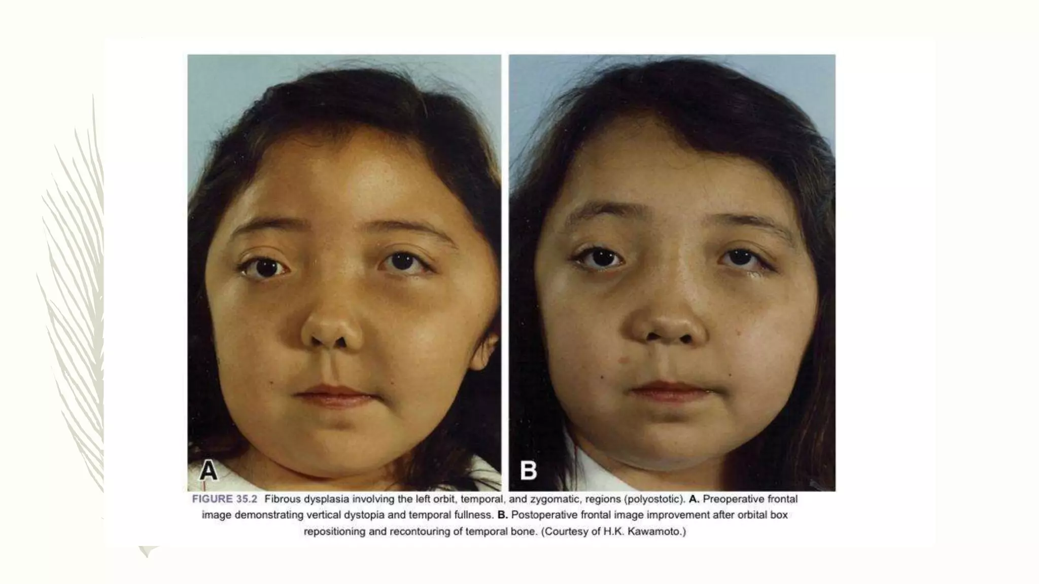 Craniofacial Tumors and Condition | PPTX