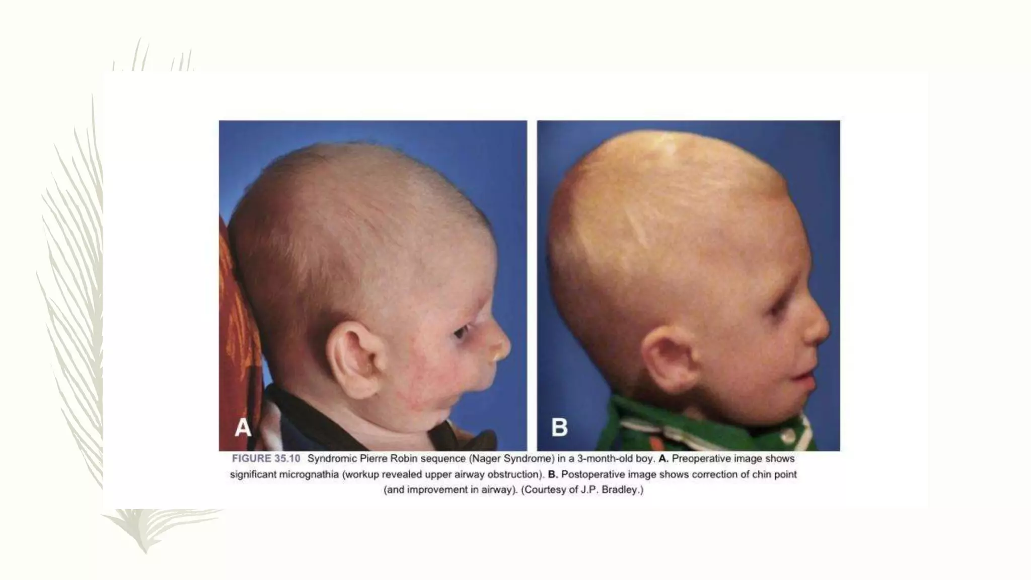Craniofacial Tumors and Condition | PPTX