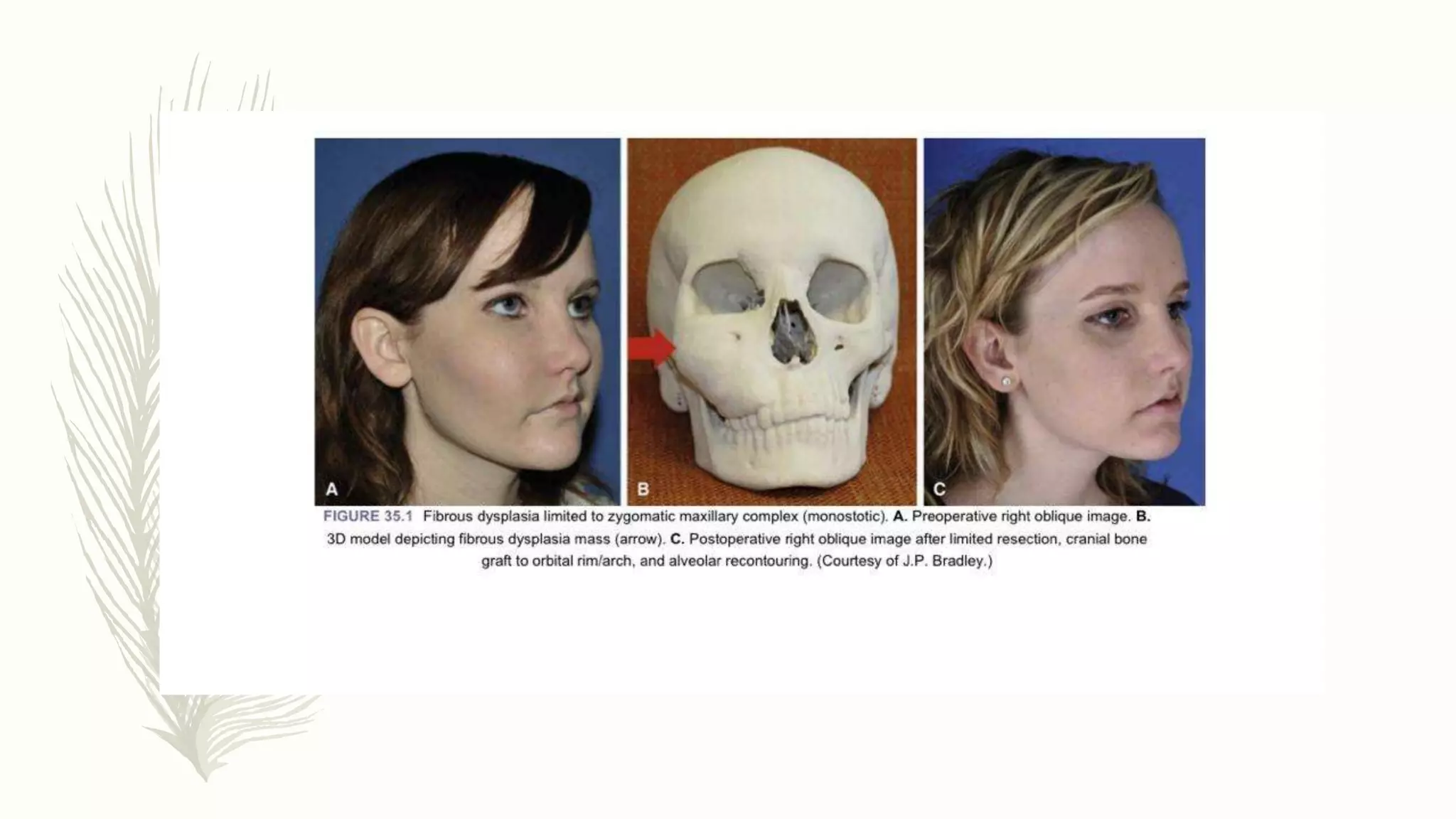 Craniofacial Tumors and Condition | PPTX