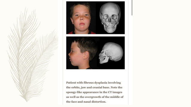 Craniofacial Tumors and Condition | PPTX