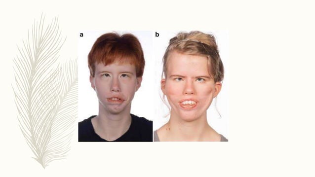 Craniofacial Tumors and Condition | PPTX