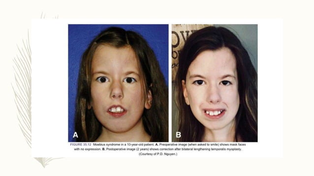 Craniofacial Tumors and Condition | PPTX