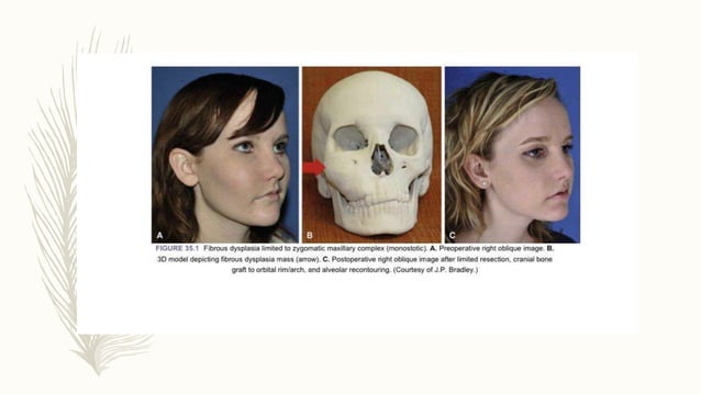 Craniofacial Tumors and Condition | PPTX