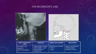 Craniometric lines | PPTX