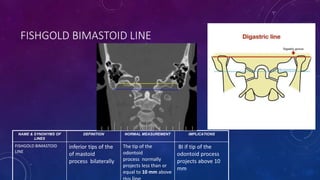Craniometric lines | PPTX