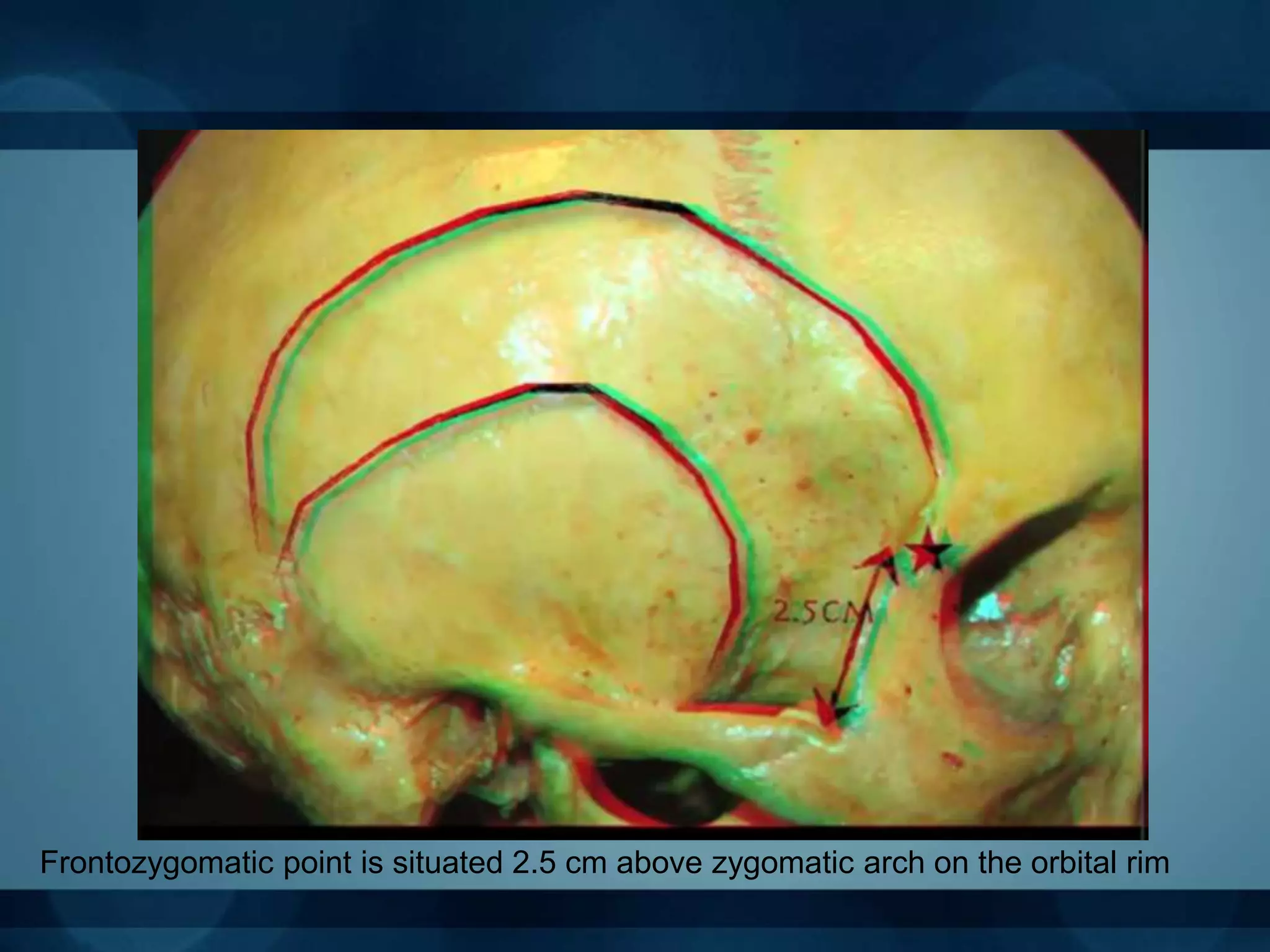 Craniometric points | PPT