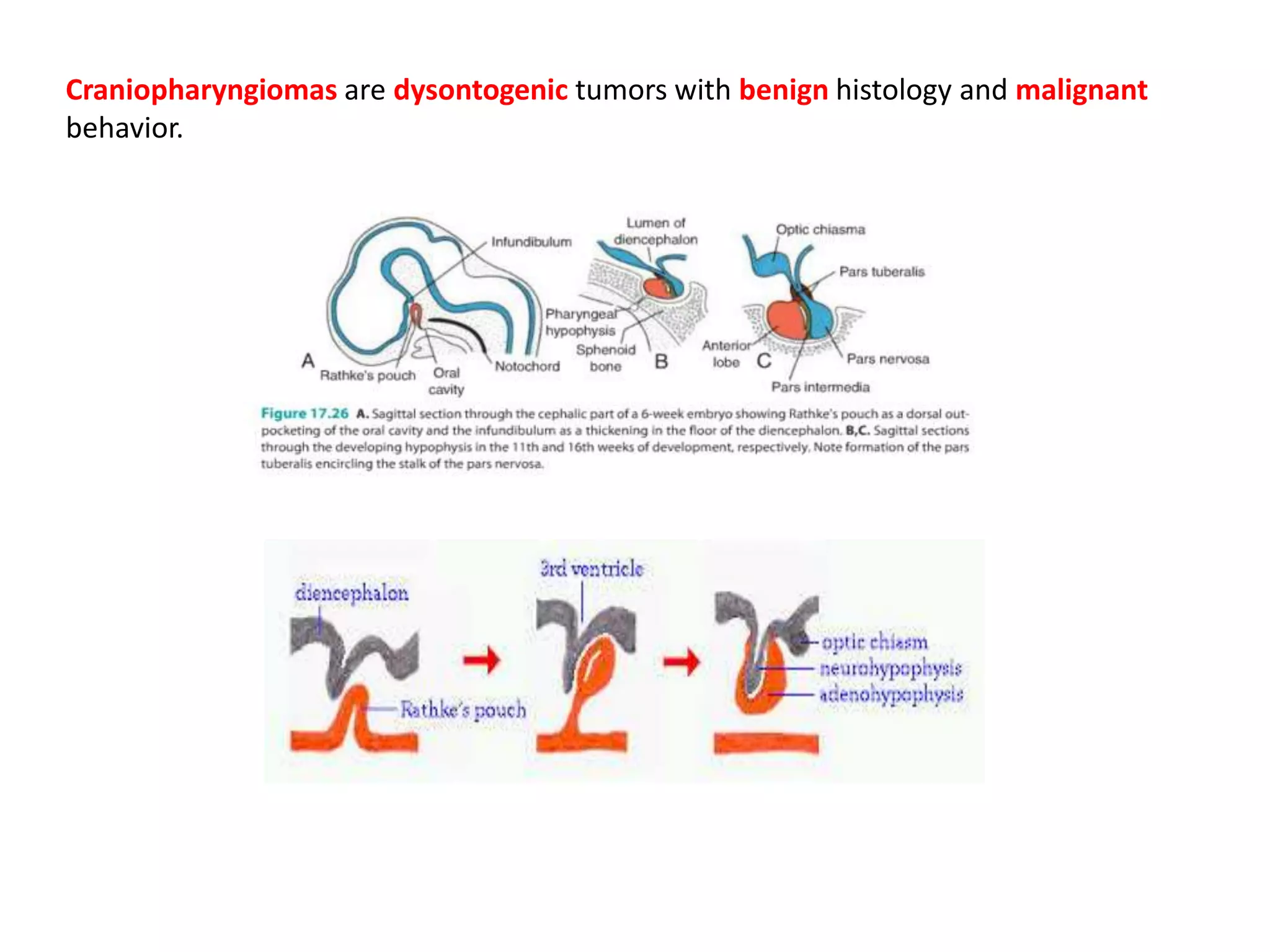 Craniopharyngioma-full lecture | PPTX