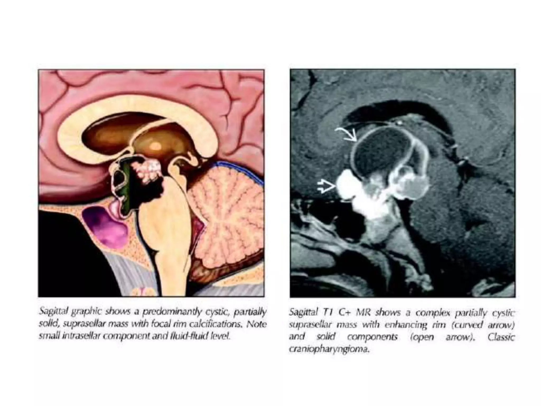 Craniopharyngioma | PPTX