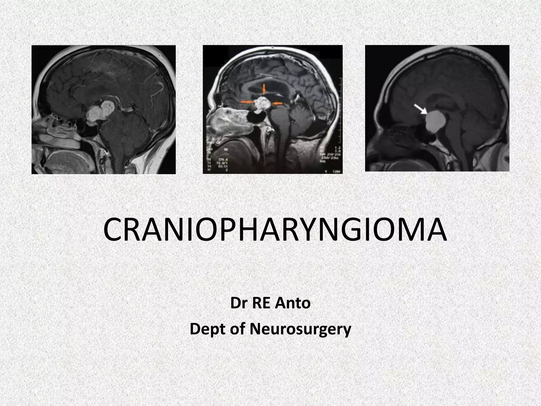 Craniopharyngioma | PPTX