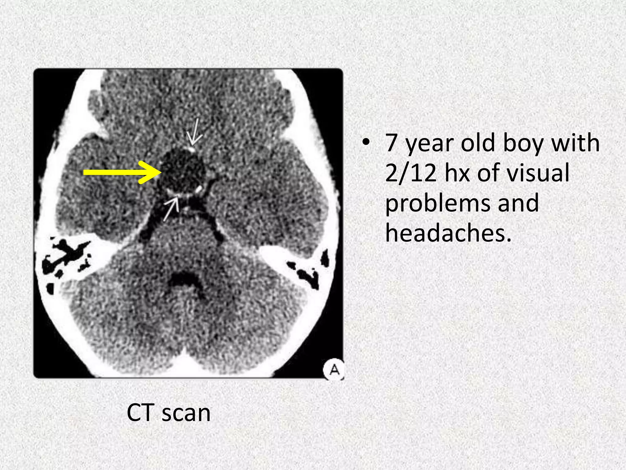Craniopharyngioma | PPTX