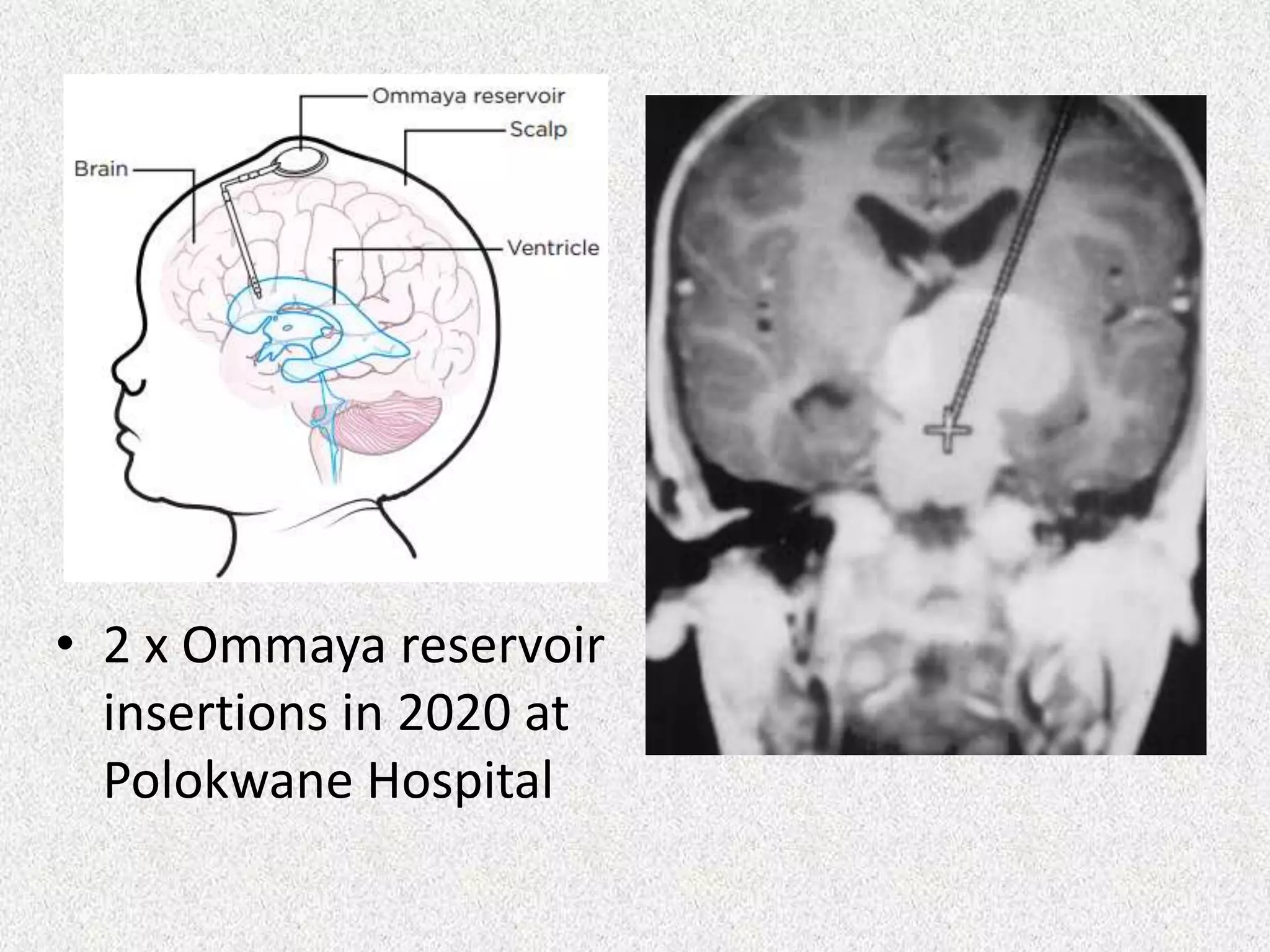 Craniopharyngioma | PPTX