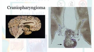 craniopharyngioma who grade 1 slide show.pdf
