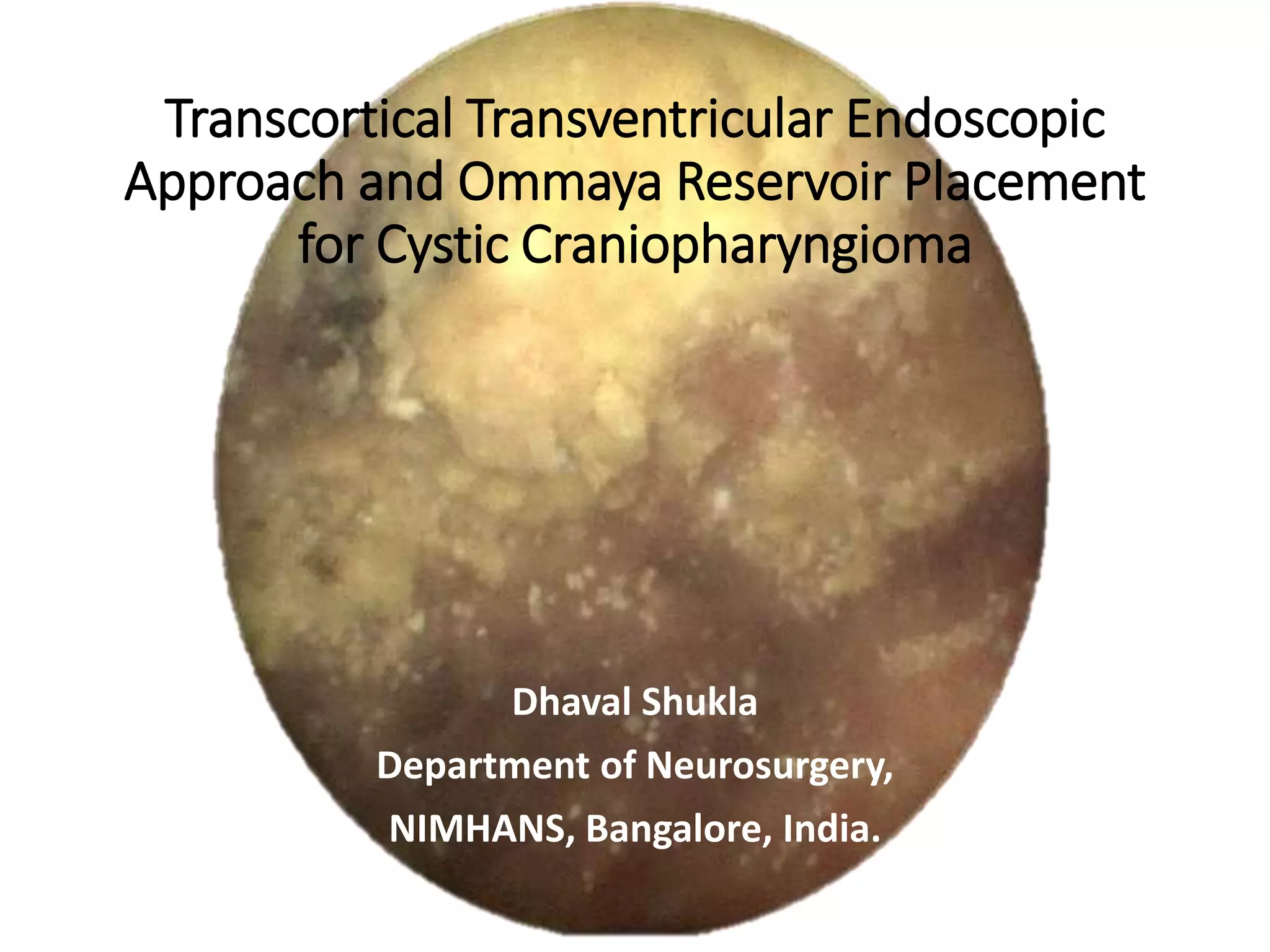 Craniopharyngioma endoscopy | PPTX