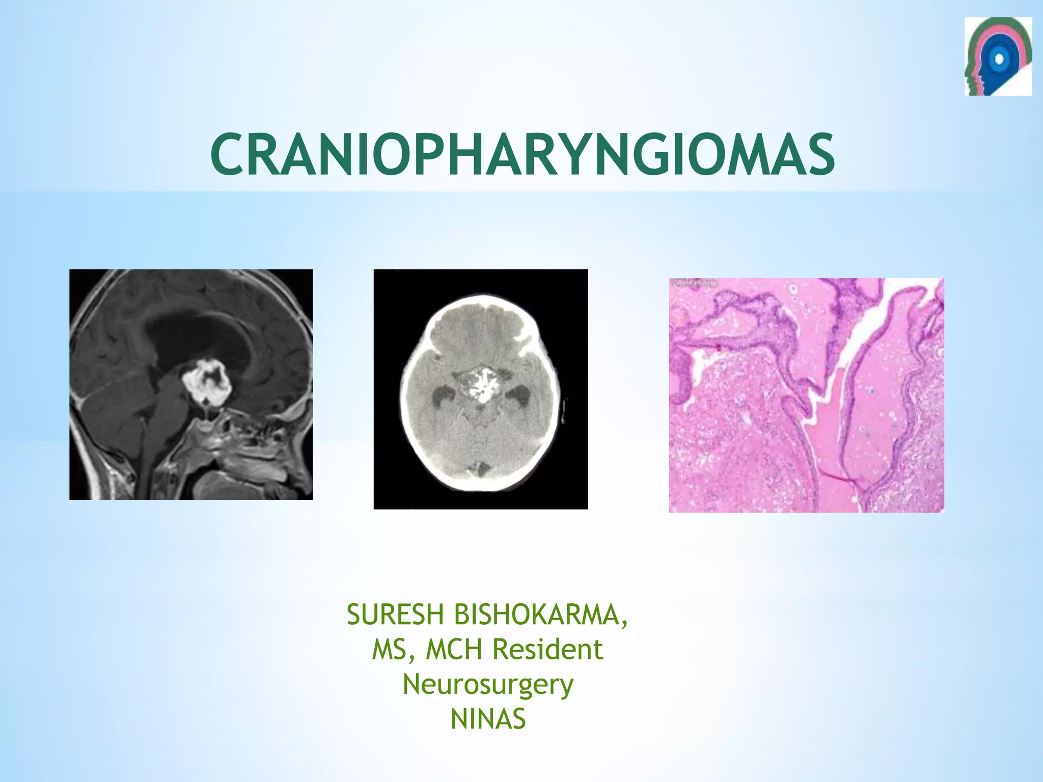 Craniopharyngiomas | PPTX