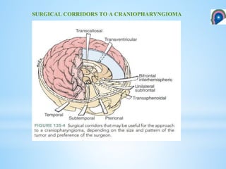 Craniopharyngioma Anatomy