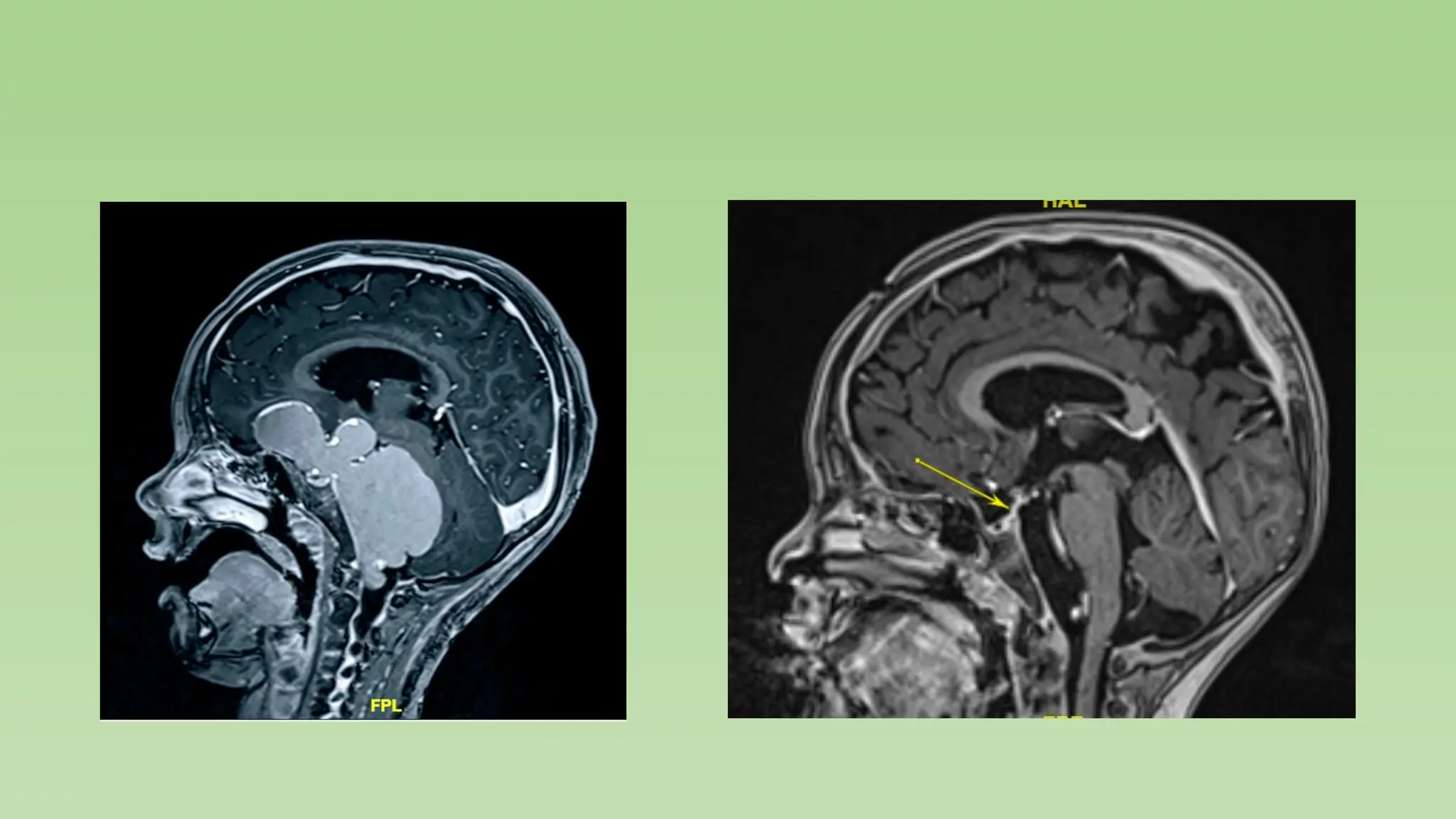 CRANIOPHARYNGIOMA THREE ENDOSCOPIC APPROACHES | PPTX