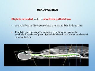 Craniospinal irradiation | PPTX