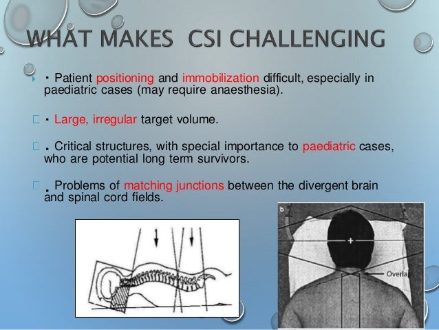 Craniospinal irradiation