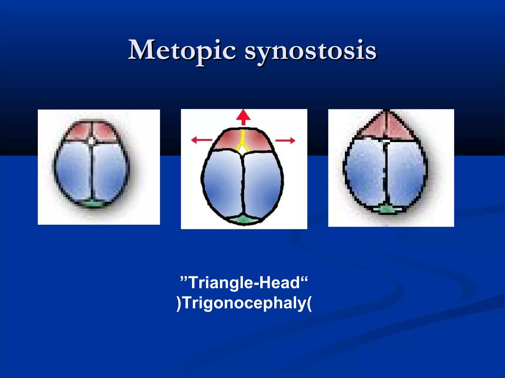 Craniostenosis | PPT