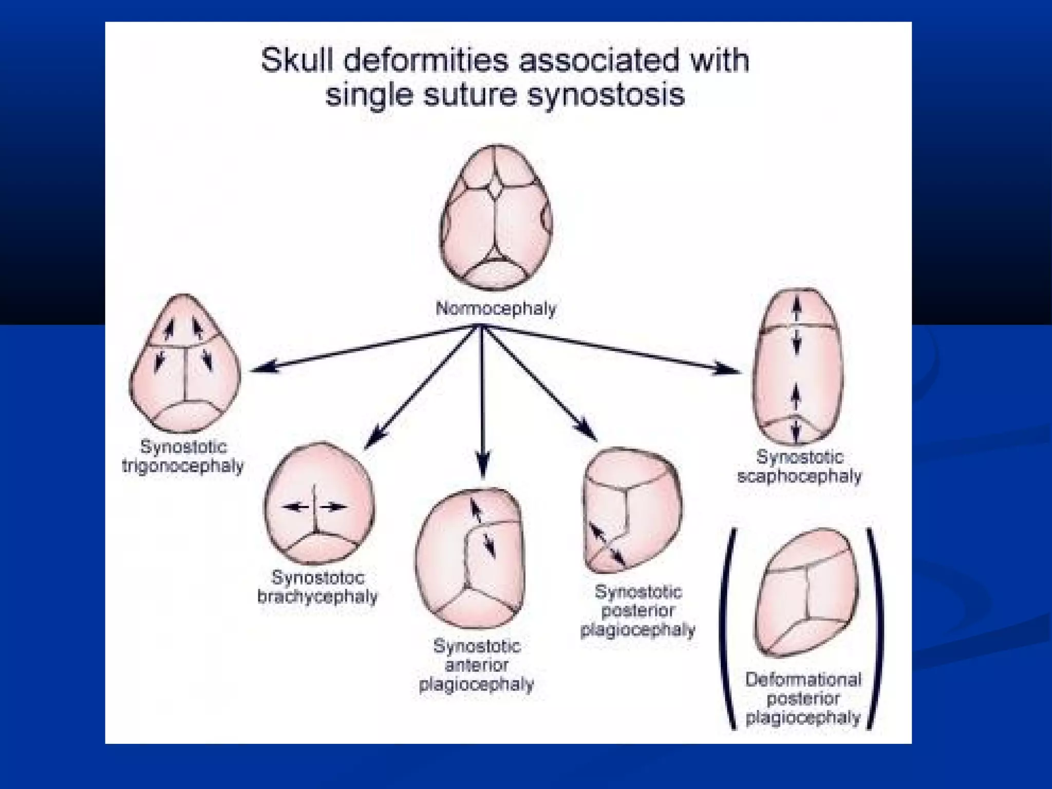 Craniostenosis | PPT