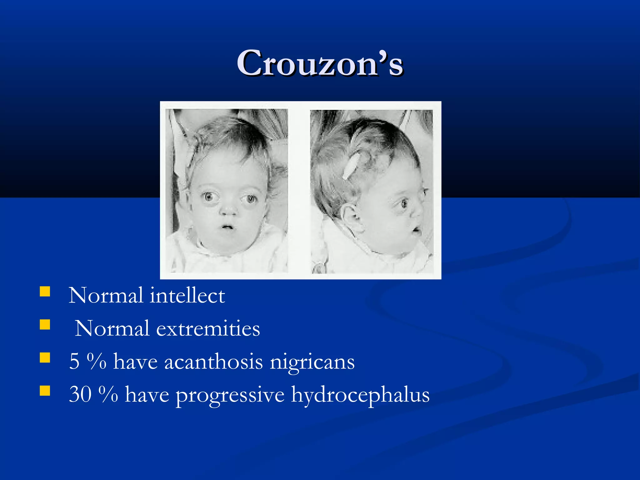 Craniostenosis | PPT
