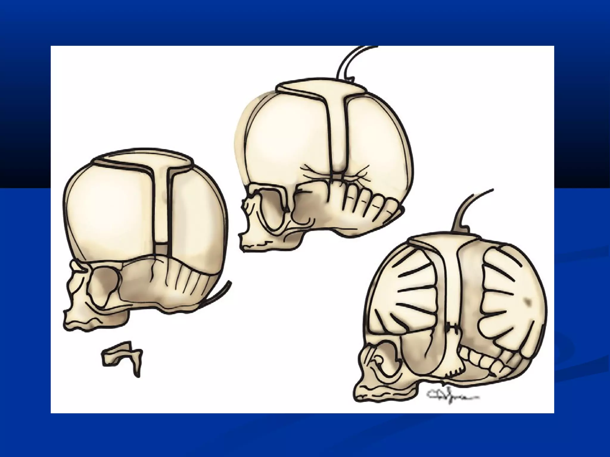 Craniostenosis | PPT