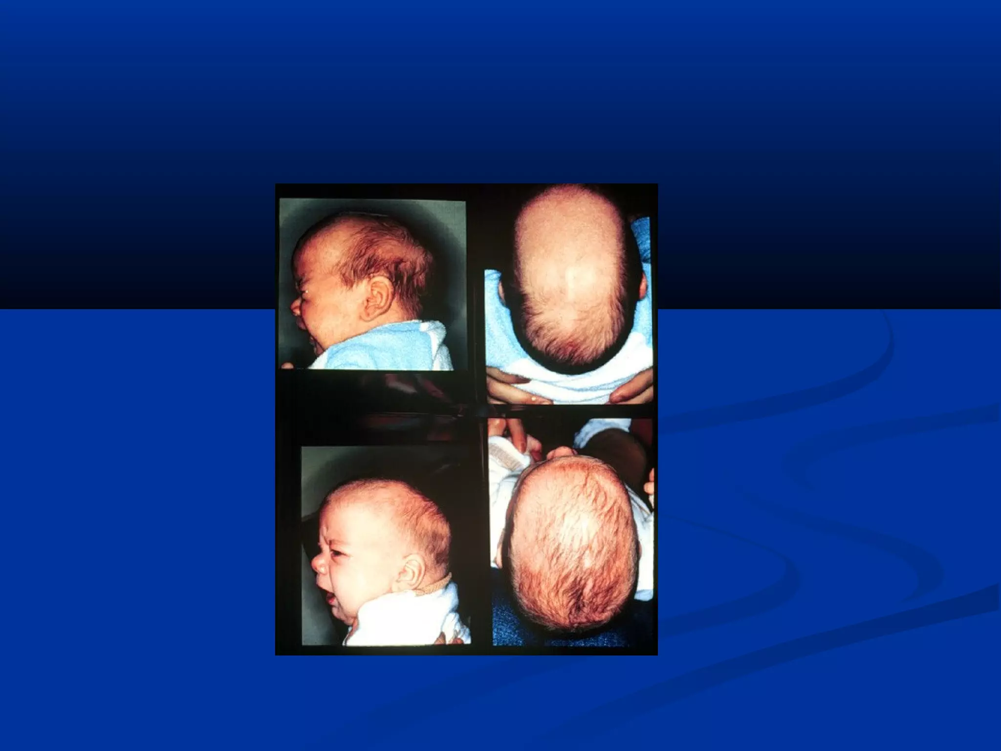 Craniostenosis | PPT