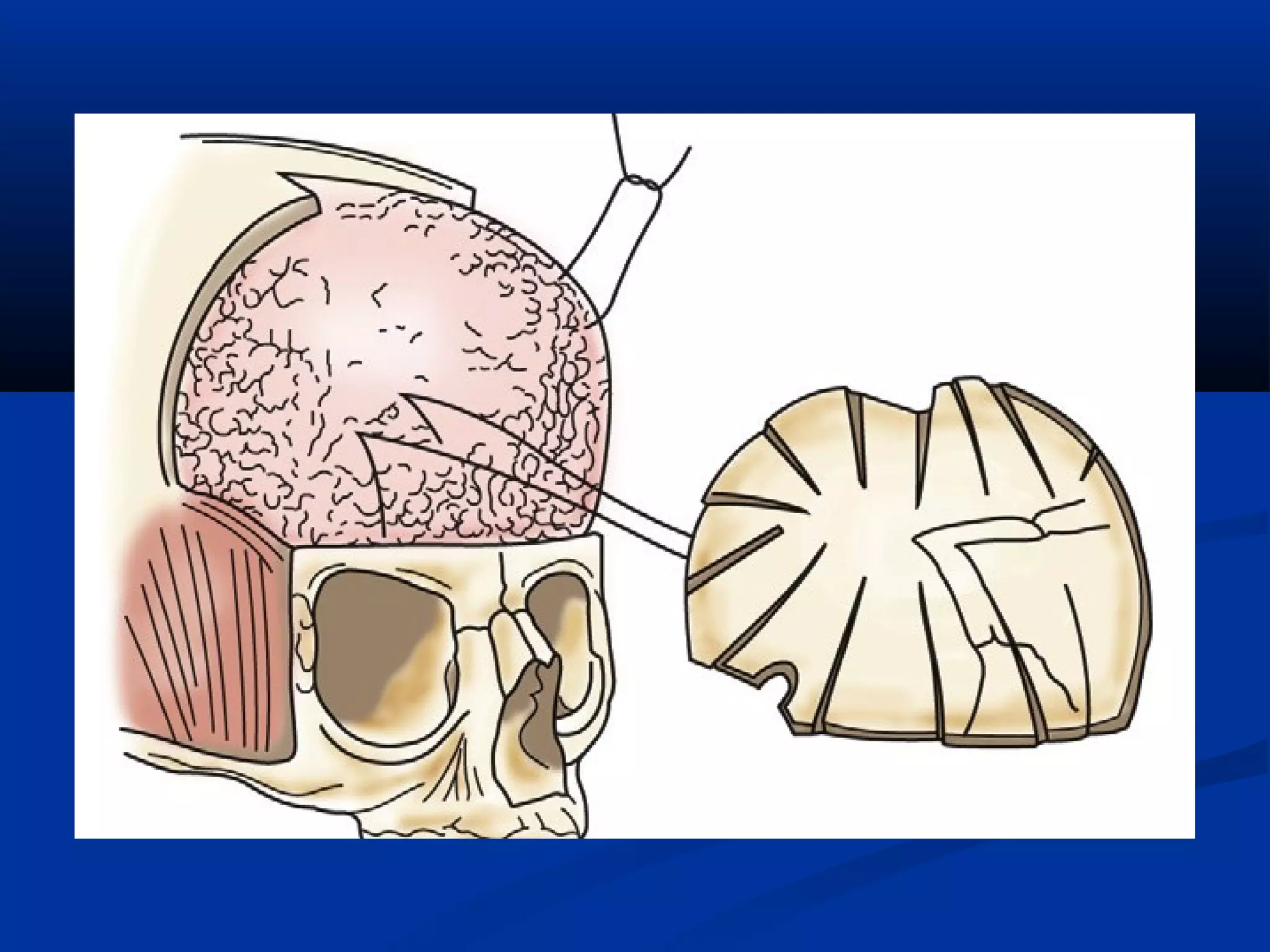 Craniostenosis | PPT