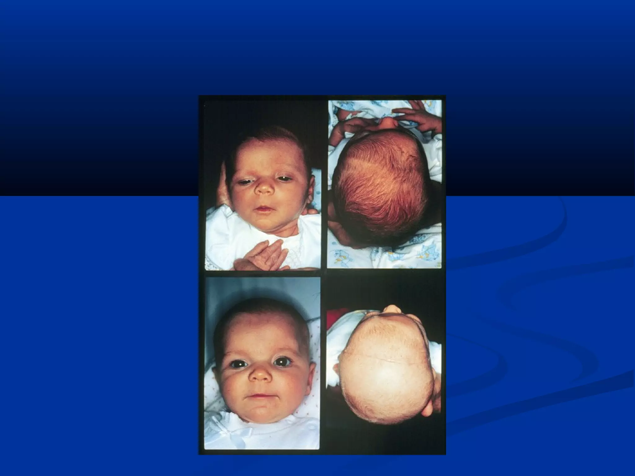 Craniostenosis | PPT