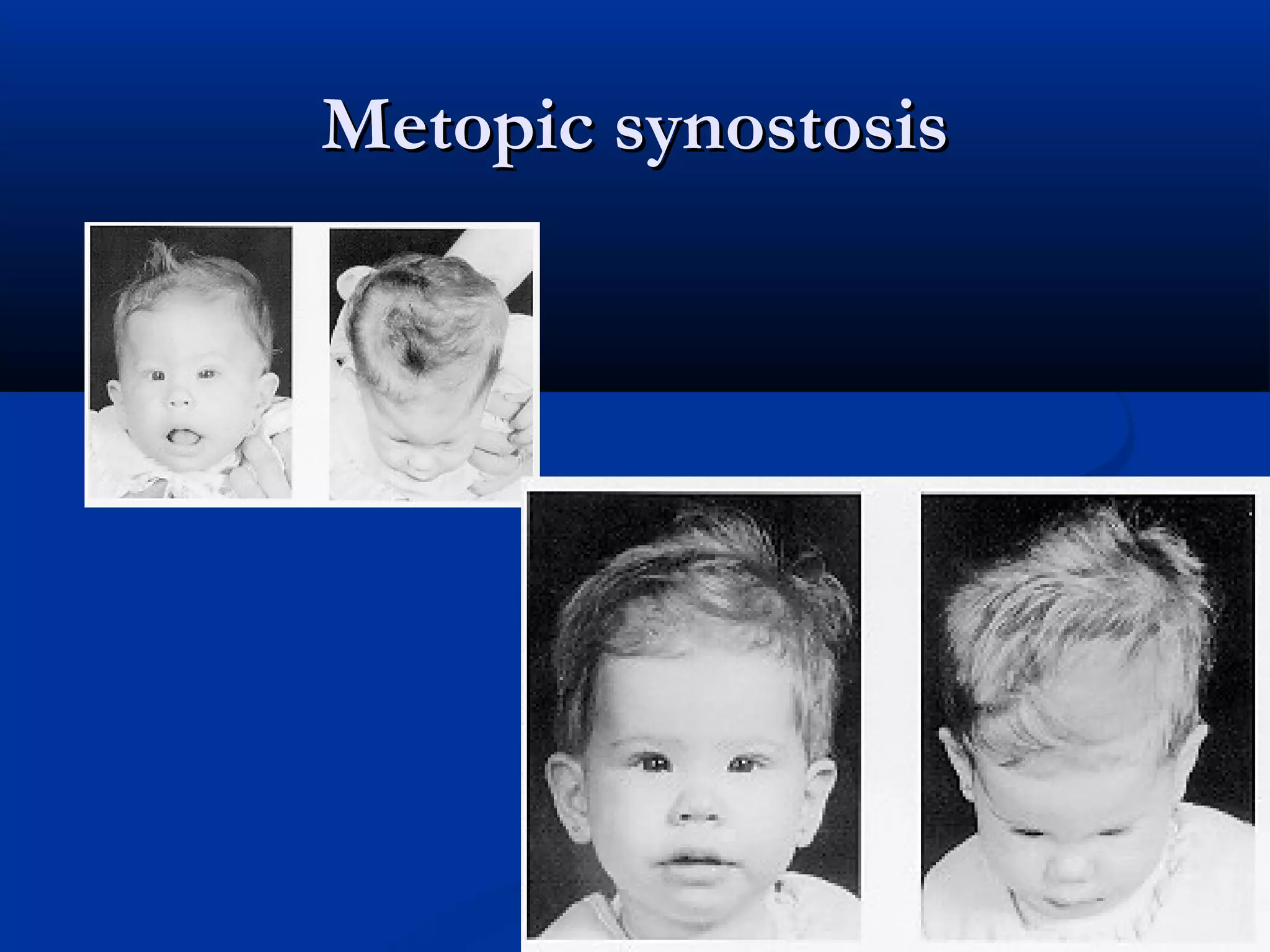 Craniostenosis | PPT